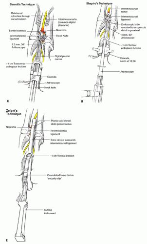 Endoscopic Plantar Fascia Release Gastrocnemius Recession And