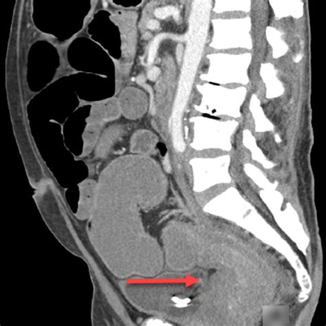 Ct Cross Sectional View Red Arrow Demonstrates Infiltrative Soft