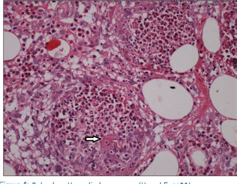 Figure 1 From Subcutaneous Phycomycosis Presenting With Multiple