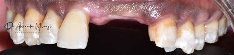 How To Maintain A Midline Diastema With A Fixed Prosthesis In A Financially Constraint Patient
