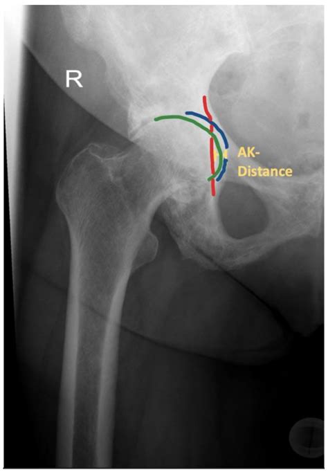 Anterior Hip Replacement X Ray At Betty Watkins Blog