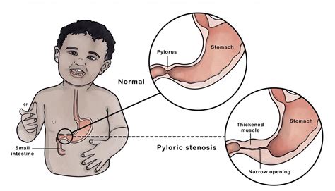 Pyloric Stenosis Olive Shaped Mass