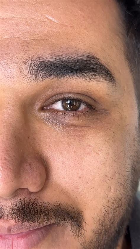 ‎کیلینیک تخصصی پوست و مو پگاه عسکرنیا‎ ‎رفع تیرگی زیر چشم به صورت