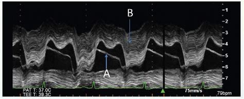 Syncope Thoracic Key
