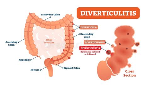 Diverticulitis Vector Illustration Stock Illustrations 87