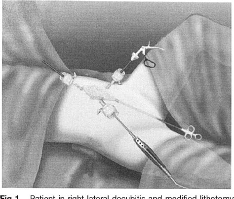 Figure 1 From Transvaginal Laparoscopic Donor Nephrectomy Semantic