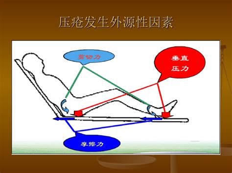 压疮的分期及护理PPT课件 202资源网