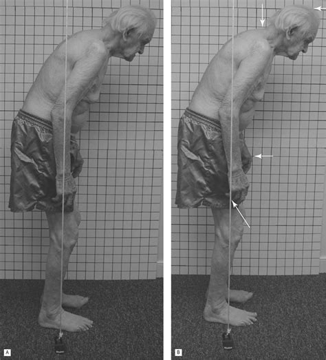 Posture Musculoskeletal Key