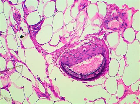 Pathfinder Surgical Pathology Snapshot 6 An Ulcerated Skin Lesion Of