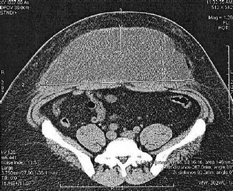 Multi Slice Computed Tomography Of The Abdomen Axial Plane Liquid