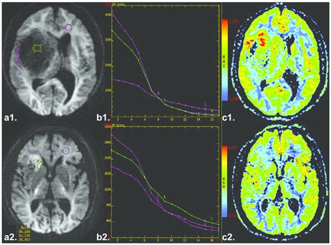 A1 And A2 Axial Diffusion Weighted Trace Image B4500 Secmm 2
