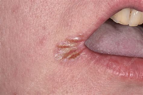 Angular Cheilitis I Have Angular Cheilitis And Idk If Its Caused By