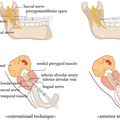 Inferior Alveolar Nerve Block Using The Anterior Technique 48 Off