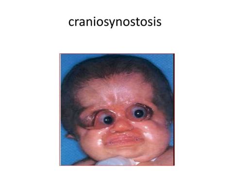Proptosis In Ophthalmology Pptx