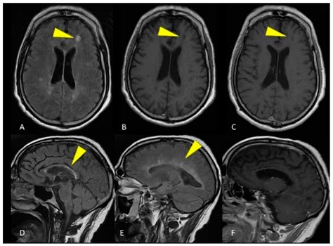Autoimmune Demyelinating Diseases Encyclopedia Mdpi