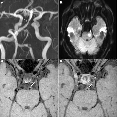 Frontiers Vertebrobasilar Junction Angle Over 90° A Potential