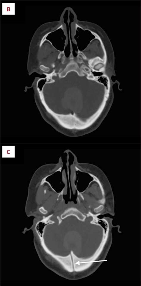 Figure 2 From A Rare Case Of An Intracranial Dermoid Cyst With Atypical Appearance On Computed