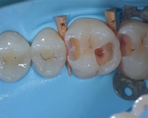 The Hierarchy Of Bondability — Alleman Center Of Biomimetic Dentistry