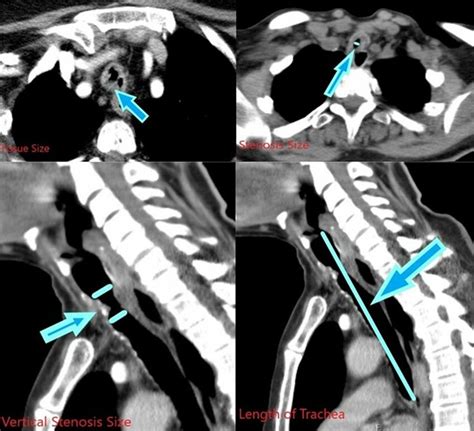 A Tracheal Stenosis B Tracheal Stenosis Dimensions Download Scientific Diagram