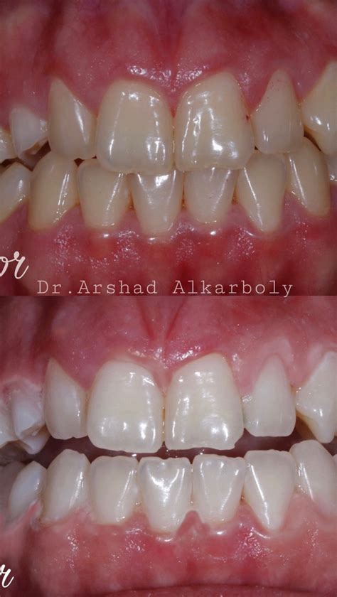 ‎دارشد الكربولي‎ ‎شون غيرت نانسي عجرم ابتسامتها؟🦷 طب اسنان