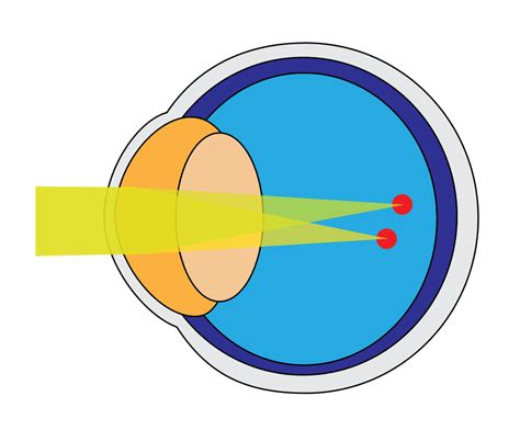 Learning About Astigmatism Adam Hart Md Ophthalmologist