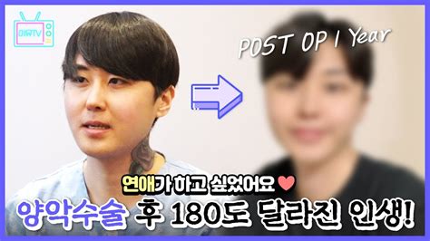 양악수술 후 180도 달라진 인생 남자양악수술 후기 Youtube