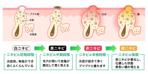 黒ニキビの治し方とケアする方法を解説即効で治すために押し出すのはあり