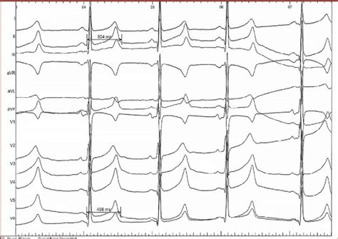 It Shows A Flat And Prolonged St Segment With A Late Onset
