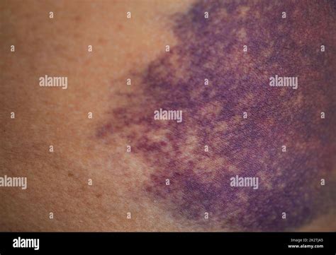 Buttock Injury Hi Res Stock Photography And Images Alamy