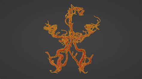 3d Model Of Brain Arteriovenous Malformation By Azekapeka