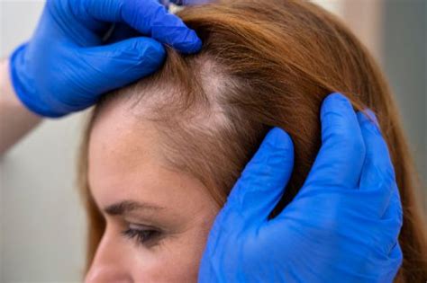 Causas de la alopecia en la mujer Descubre por qué se produce la pérdida de cabello femenina