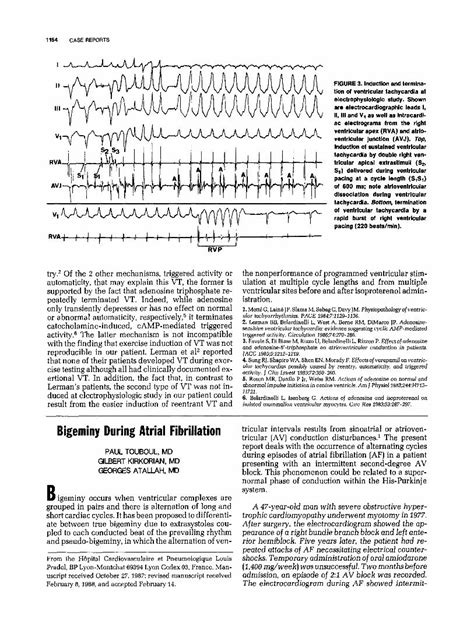 Pdf Bigeminy During Atrial Fibrillation Dokumentips