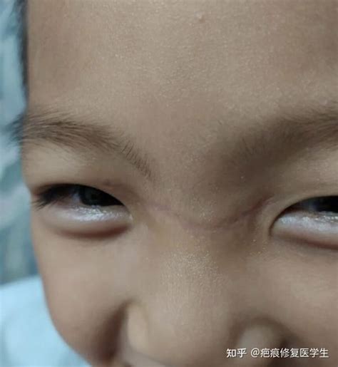 结痂脱落后留疤怎么才能淡化疤痕？ 知乎