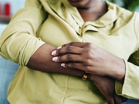 Chronic Idiopathic Urticaria Triggers