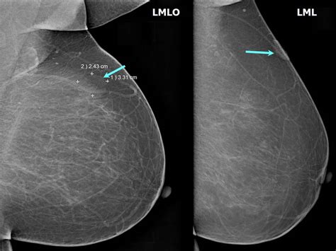 Stellate Lesions Of The Breast Wmpvd