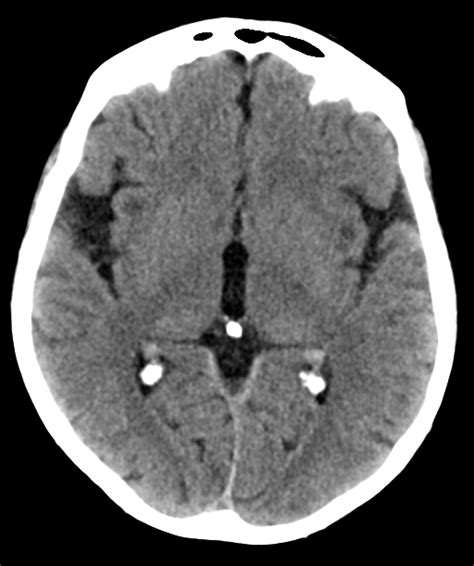 Radiopaedia Case Choroid Plexus Calcification Through The Foramina Of