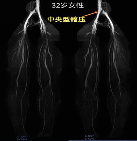 放射科开展不打药下肢静脉MRV新技术让下肢静脉检查更轻松 我院 方案 治疗