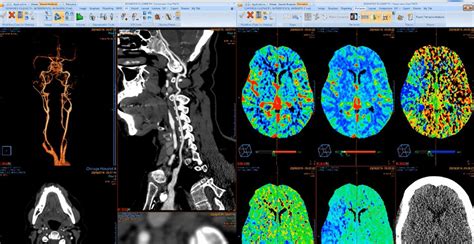 Philips Vue PACS Add Advanced Applications PT Aneka Medika Indonesia