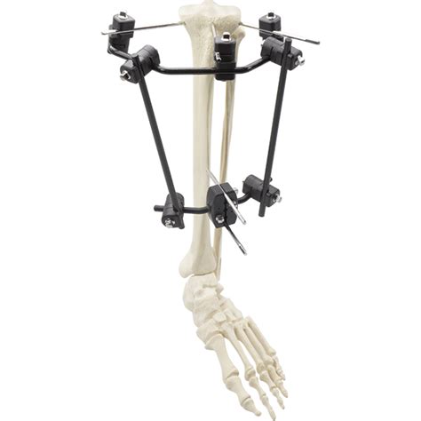China Φ8 0 Series External Fixation Fixator Proximal Tibia Semicircular Frame Factory And