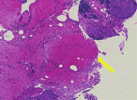 Histopathological Slide Of Patients Pulmonary Lymph Node Biopsy