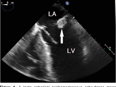 Figure 1 From Giant Caseous Calcification Of The Mitral Annulus