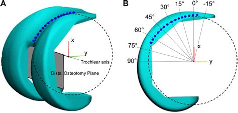 Variations In Trochlear Morphology Of Contemporary And Legacy Total Knee Arthroplasty Prostheses