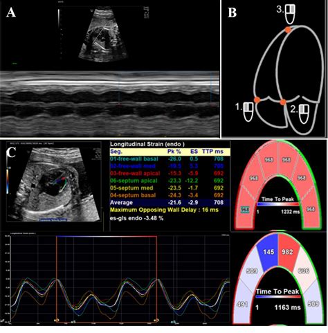 Figure 1 From Right Ventricular Systolic Function And Associated Anatomic Risk Factors In
