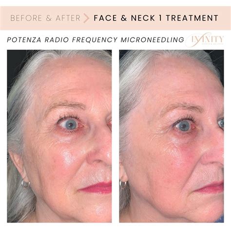 Radio Frequency Microneedling — Infinity Medspa And Wellness Charlotte Nc