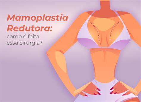 Mamoplastia redutora como é feita essa cirurgia Alexandre Kataoka