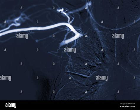 Image Of Angioplasty Balloon Angioplasty And Percutaneous Transluminal