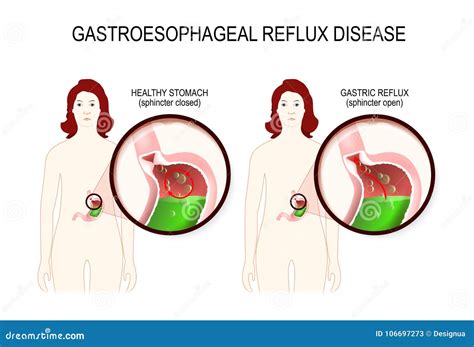 Gastroesophageal Reflux Disease Gerd Cartoon Vector Cartoondealer