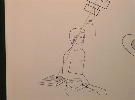 The Profher Proximal Fracture Of The Humerus Evaluation By Randomisation Trial A Pragmatic