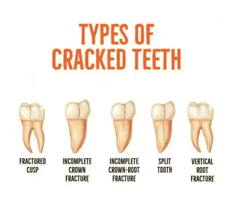 Types Of Tooth Cracks A Dentists Guide