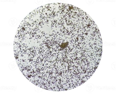 Microscopic Image Of Urinalysis Abnormal Urine Exam Uric Acid